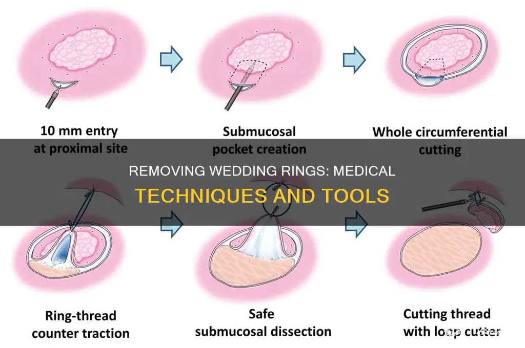 Removing Wedding Rings: Medical Techniques And Tools | ShunBridal